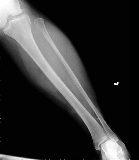 Figure 1 From Dislocation Of The Proximal And Distal Tibiofibular