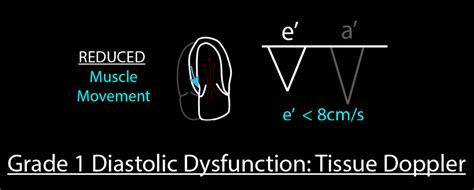 How To Measure And Grade Diastolic Dysfunction Using Echocardiography Pocus 101