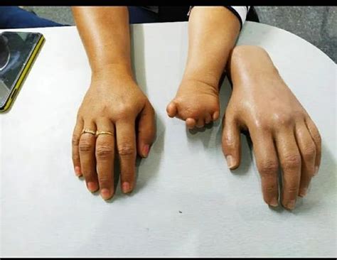 Upper Limb Silicone Partial Hand Prosthesis At Rs 65000 In Lucknow Id