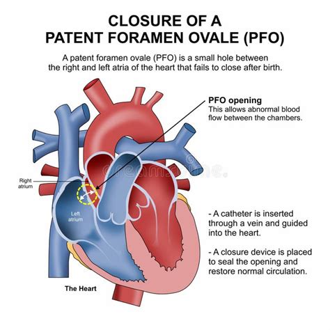 Patent Foramen Ovale Pfo Heart Flashcard Stock Image Illustration