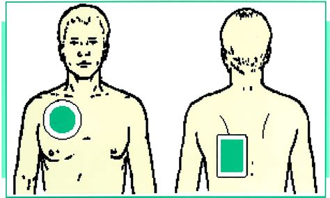Cardioversion Circulation