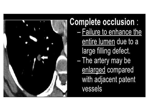 Pulmonary Embolism Radiology Imaging Pptx