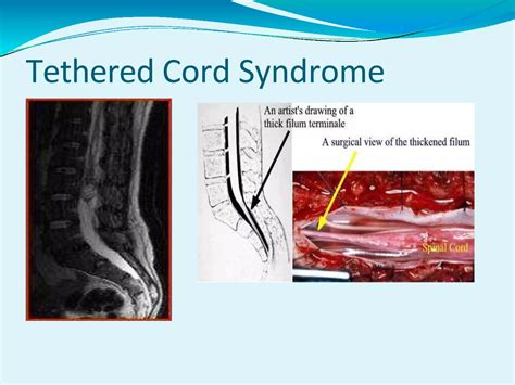 Spinal Dysraphism Adnan Al Banna Pdf