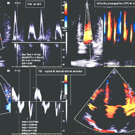 Pdf Diastolic Dysfunction In Asymptomatic Type 2 Diabetes Mellitus With Normal Systolic Function