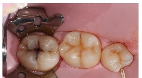 Solved What Icdas Classification Can We Use For These Car