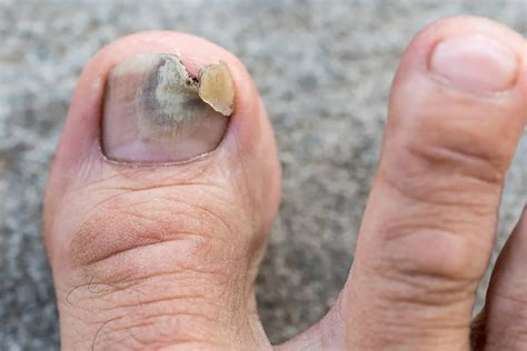 Thick Toenails Causes Home Remedies And Podiatric Care The Foot Practice