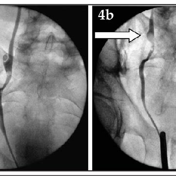 A And B Retrograde Pyelogram Showing A True Congenital Diverticulum Download Scientific Diagram