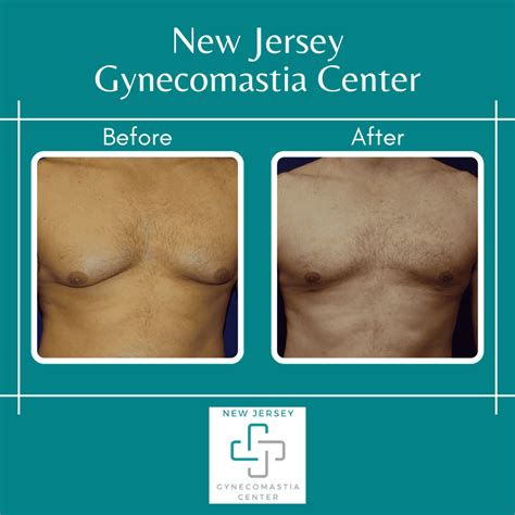 Gynecomastia Surgery Nj New Jersey Gynecomastia Center