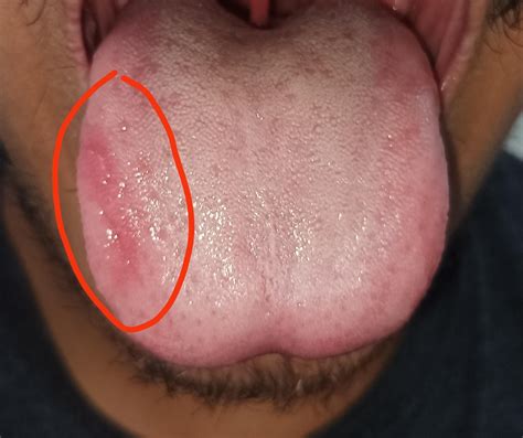 23m Asian Is This Redness Or Line On My Tongue Normal Raskdentists