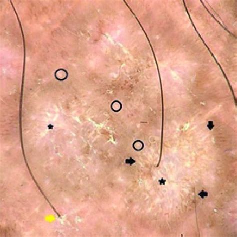 Sex Distribution Of Patients With Primary Localized Cutaneous Amyloidosis Download Scientific