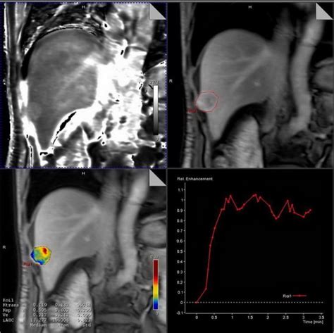 Example Of Evaluation For Perfusion Parameter By The Tissue 4d Tool T1
