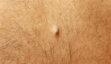 Enlarged Sebaceous Gland Treatment Treatment Of Sebaceous Hyperplasia