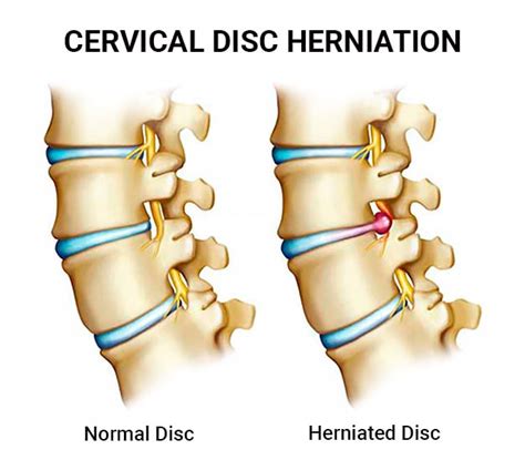 Herniated Cervical Disc