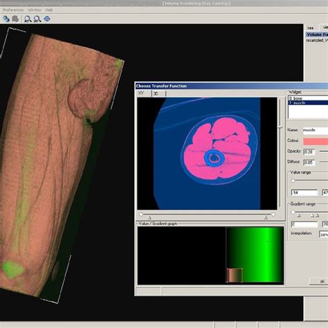 Digitally Reconstructed Radiograph View Of A Ct Scan Volume And The