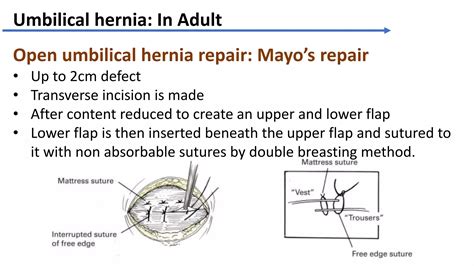 Femoral Hernia With Umbilical Hernia Pptx