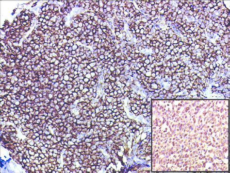 Tumour Cells Express Syndecan1 Cd138 And Show Lambda Light Chain Download Scientific Diagram