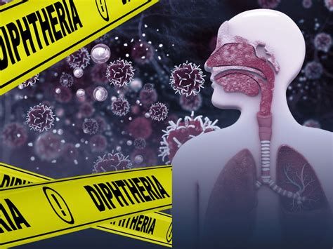 Difteria Síntomas Complicaciones Y Tratamiento