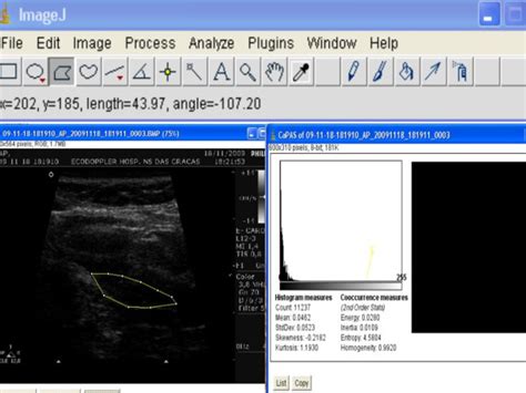 Hypoechoic Lipid Carotid Plaque And Capas Analyzes Left Panel Download Scientific Diagram