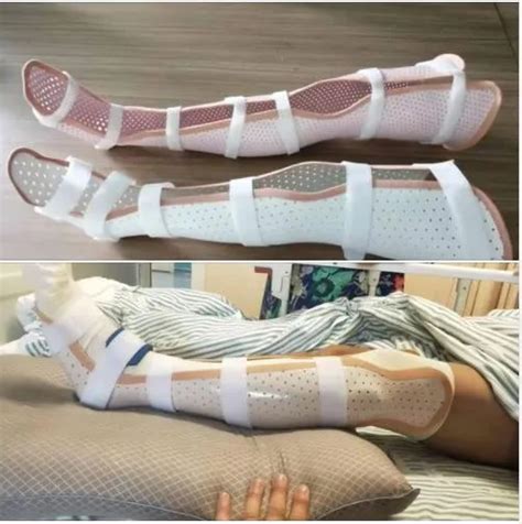 Thermoplastic Splinting Material Orthopedic Splint Sheet Splint And Thermoplastic Sheet Medical