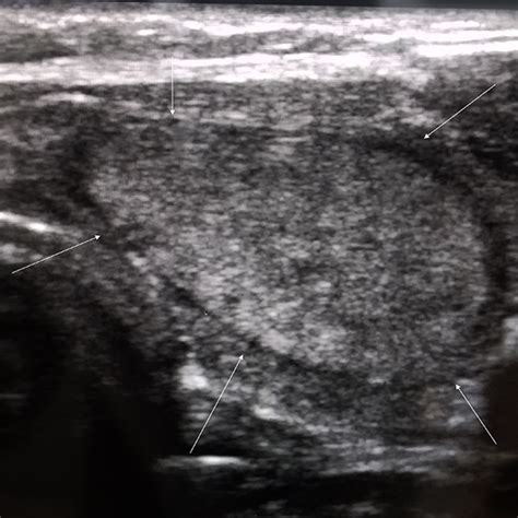 Transverse Axis Grey Scale Ultrasound Image Through The Left Thyroid