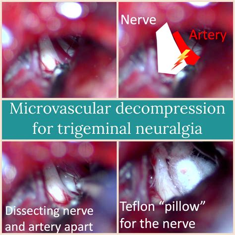 Endoscopic Microvascular Decompression At Douglas Jacobson Blog