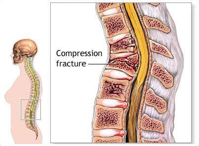 Compression Fracture Diagram