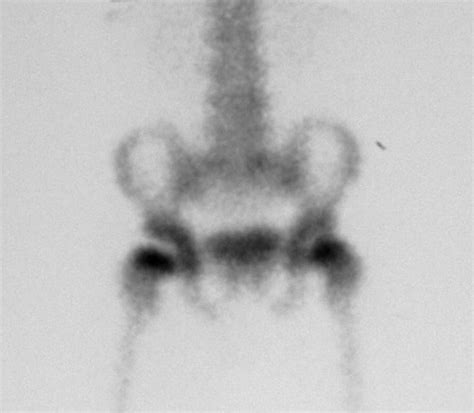 Bone Scan Imaging Interpretation Quiz Flashcards Quizlet