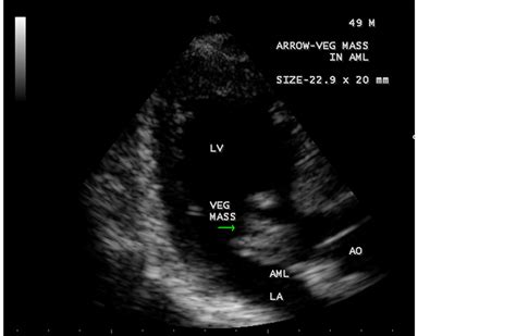 Rheumatic Mitral Valvulitis With A “giant Vegetation”—a Case Report