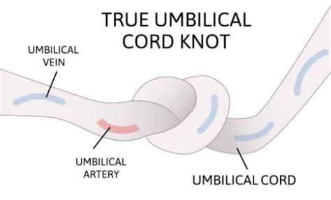 Umbilical Cord Knot What You Need To Know Healthy Pregnancy