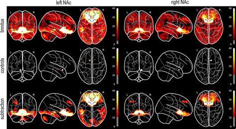 Glass‐brain Visualizations Of Voxelwise Rsfc With Leftright Nac Seed