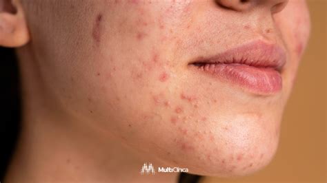 Conheça Os Principais Tipos De Acne E Como Tratar Multiclinica Bh