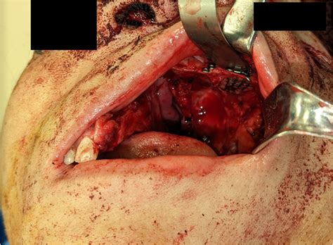 Midface Degloving Approach For Total Maxillectomy Without Orbital