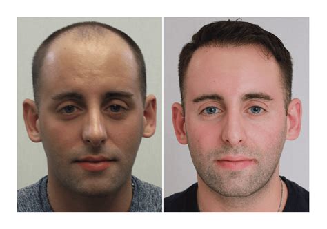 Hair Transplant Beforeafter Results For Men Bosley Hair Transplant