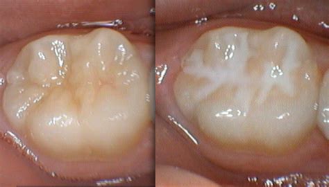 Fissure Sealant Application Mrgigi Dental Clinic
