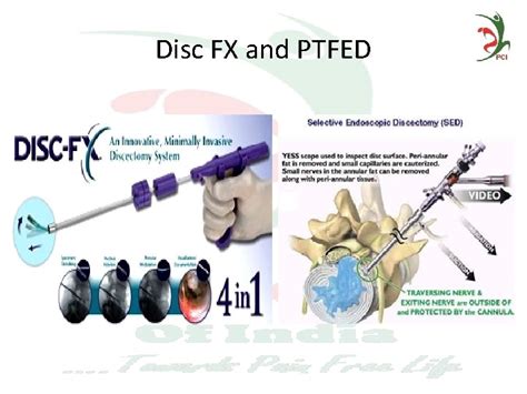 Lumbar Herniated Disc Treated With Percutaneous Disc Fx
