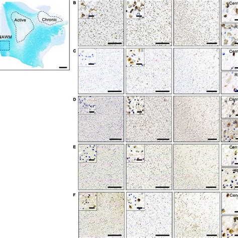Active And Chronic Ms Lesions Show Increase In Inflammation 4 Hne