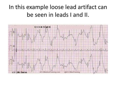 Artifacts In Ecg Pptx Heart And Cardiovascular Diseases Diseases And Conditions