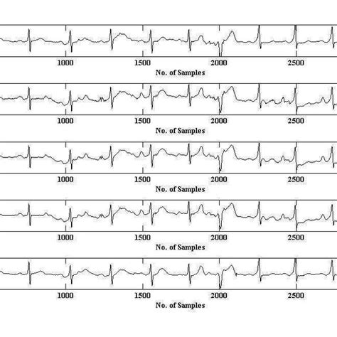 1 Ecg Signal Corrupted With Gaussian Noise At An Snr Of 125 Db
