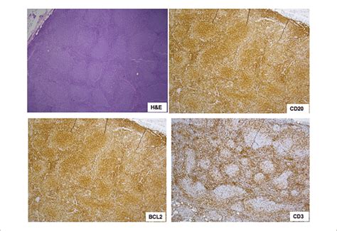 Lymph Node Hematoxylin Eosin 40× Magnification Shows Follicular Download Scientific Diagram