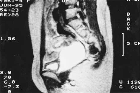 Figure 2 From Sarcoma Botryoides Of The Cervix Semantic Scholar