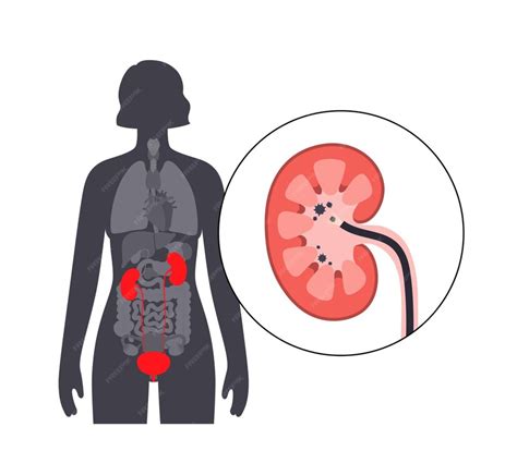Premium Vector Ureteroscopy Is A Minimally Invasive Procedure Examination And Treatment Of The