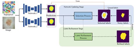 Superpixel Guided Iterative Learning From Noisy Labels For Medical Image Segmentation Plus
