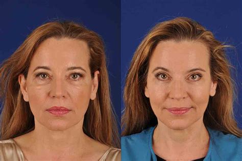 Eyebrow Lifts The Secret To Achieving A Youthful Glow Lux Injectable