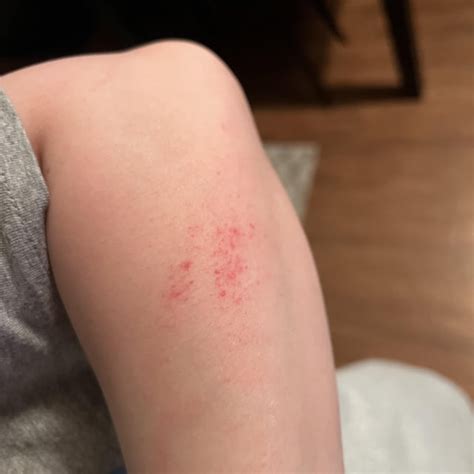 Im Scared Of The Hair Loss Rwellbutrinbupropion