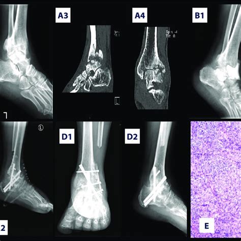 A Representative Case A 50 Year Old Man With Ankle Infected Bone