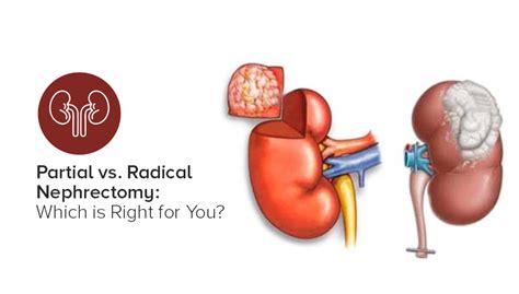 Understanding Partial And Radical Nephrectomy A Complete Guide