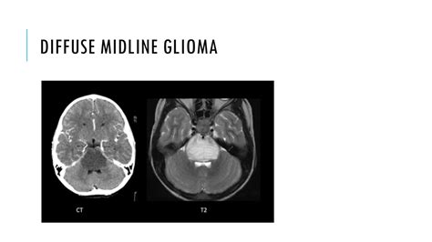 Who Cns 5 2021 Pediatric Tumor Classification And Radiology Of Most Common Pediatric Posterior