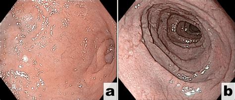 Upper Digestive Endoscopy Of Duodenum A Atrophic Mucosa And Download Scientific Diagram