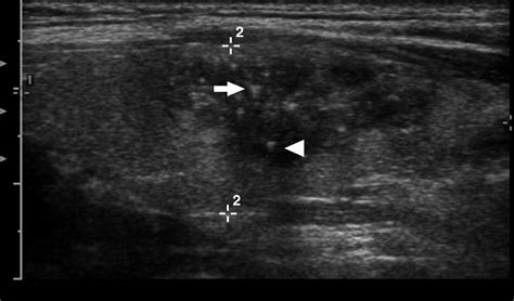 Echogenic Foci In Thyroid Nodules Significance Of Posterior Acoustic