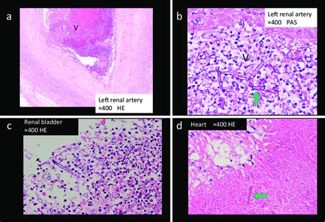 A Left Renal Artery [hematoxylin And Eosin Hande Staining ×40] The